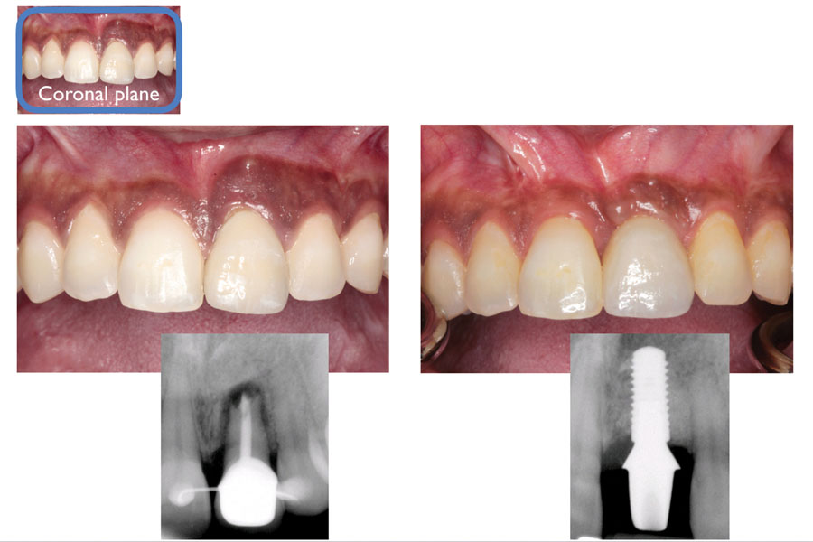 dabuleanu-5-preserving-papilla-height-by-maintaining-interproximal-bone ...