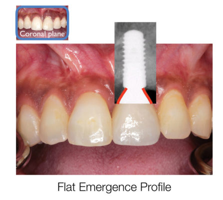 A Stepwise Approach: Restoring a Failed Maxillary Anterior Tooth