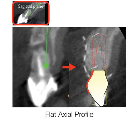 A Stepwise Approach: Restoring a Failed Maxillary Anterior Tooth