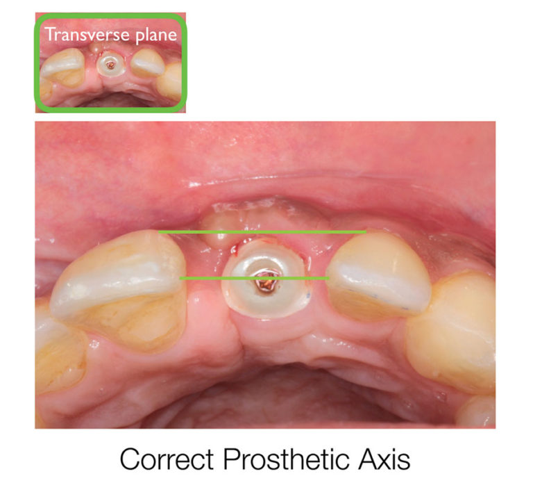 A Stepwise Approach: Restoring a Failed Maxillary Anterior Tooth