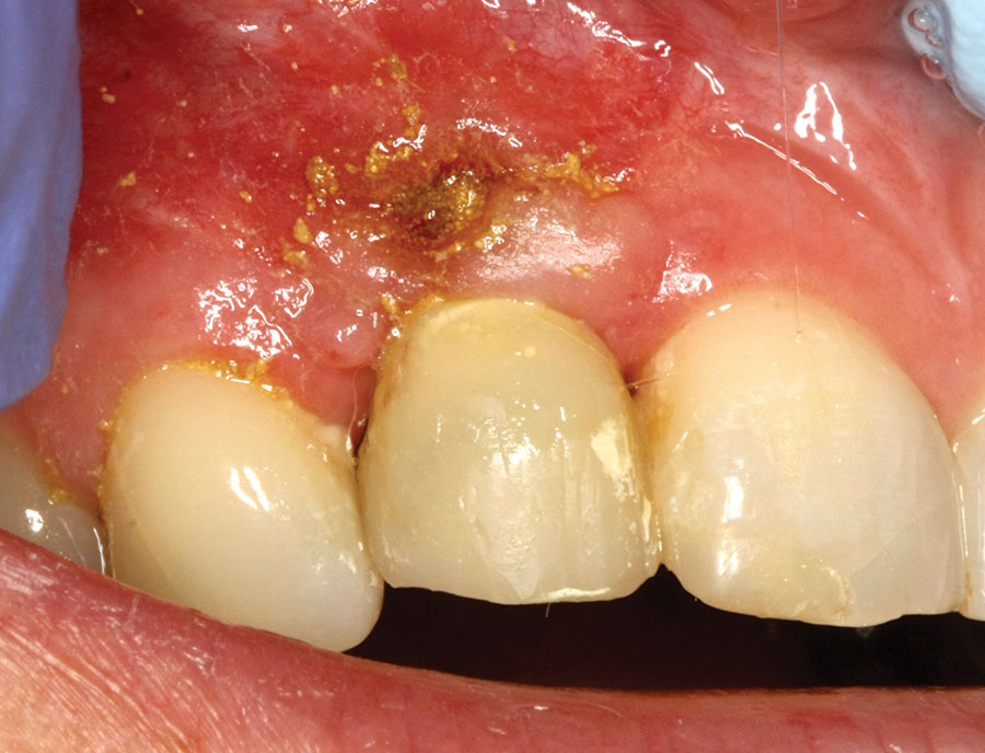 Case Report: The Titanium Smile - Oral Health Group