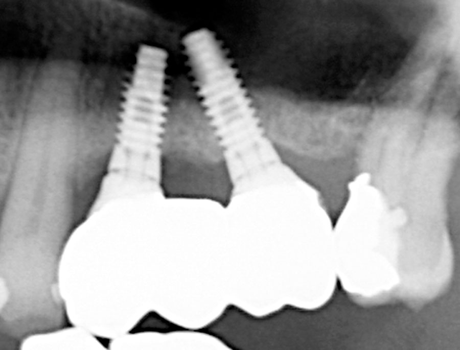 Dental Implant Prosthetics: Using a Modified Installation Technique