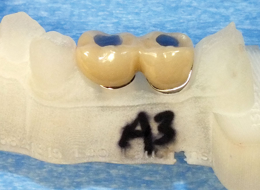 Dental Implant Prosthetics: Using a Modified Installation Technique
