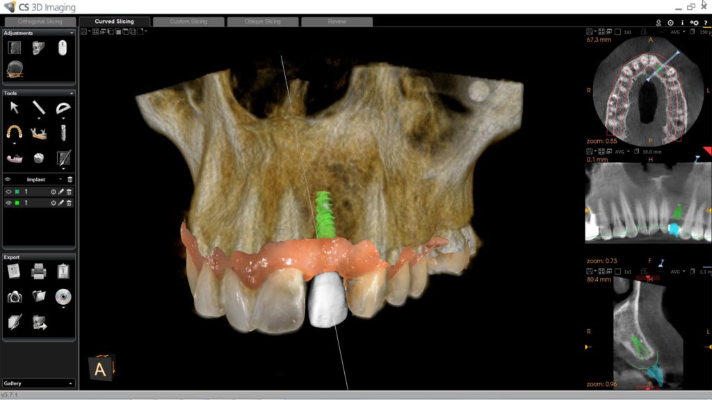 New Workflow from Carestream Dental Improves Confidence in Placing ...