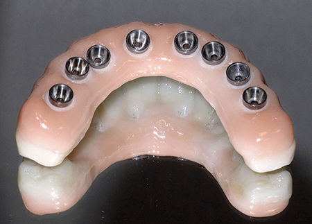 Predictable Immediate Implant Prosthetics: Part 2 - Oral Health Group
