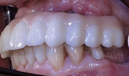 Predictable Immediate Implant Prosthetics: Part 2 - Oral Health Group