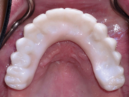 Predictable Immediate Implant Prosthetics: Part 2 - Oral Health Group