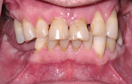 Predictable Immediate Implant Prosthetics: Part 2 - Oral Health Group