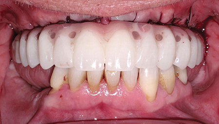 Predictable Immediate Implant Prosthetics: Part 2 - Oral Health Group