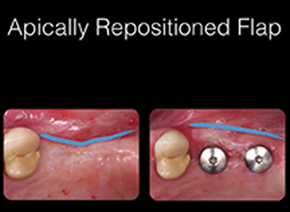Avoiding Peri-implantitis: Key Factors for Improved Clinical Outcomes