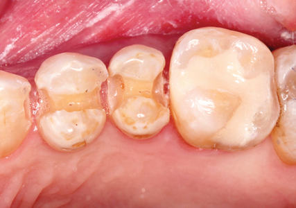 ward-figure-16-first-molar-restored-with-glass-ionomer - Oral Health Group