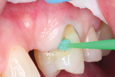 The Evolution of Glass Ionomer Restorative Materials - Oral Health Group