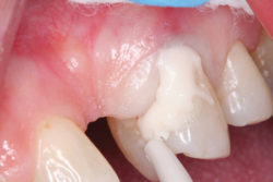 The Evolution of Glass Ionomer Restorative Materials - Oral Health Group