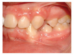 Diagnosis and Treatment Planning of Mandibular Crowding in the Mixed ...
