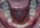Diagnosis and Treatment Planning of Mandibular Crowding in the Mixed ...