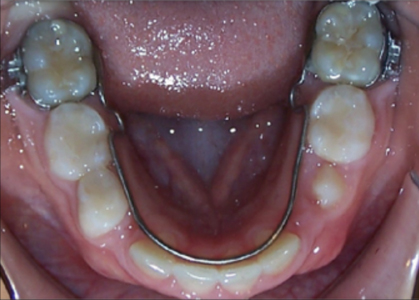 Diagnosis and Treatment Planning of Mandibular Crowding in the Mixed ...