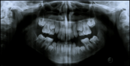 Diagnosis and Treatment Planning of Mandibular Crowding in the Mixed ...