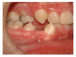 Diagnosis and Treatment Planning of Mandibular Crowding in the Mixed ...