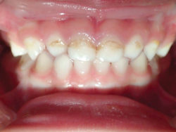 Aesthetic Restoration of the Primary Anterior Dentition - Oral Health Group