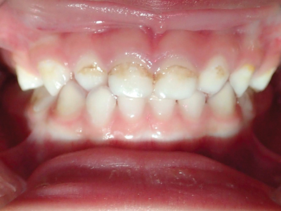 Aesthetic Restoration of the Primary Anterior Dentition - Oral Health Group