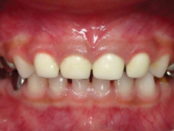 Aesthetic Restoration of the Primary Anterior Dentition - Oral Health Group