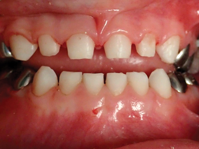 Aesthetic Restoration of the Primary Anterior Dentition - Oral Health Group