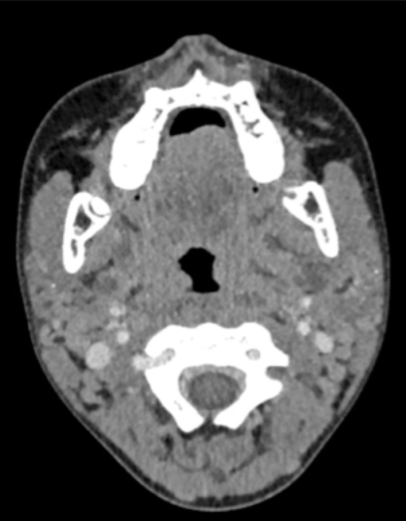 Ludwig’s Angina - A Case Report - Oral Health Group