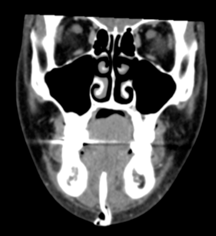 Ludwig’s Angina - A Case Report - Oral Health Group