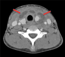Ludwig’s Angina - A Case Report - Oral Health Group