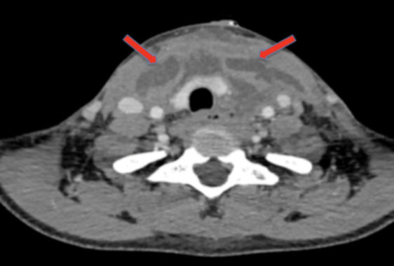 Ludwig’s Angina - A Case Report - Oral Health Group
