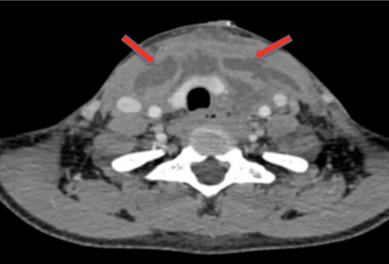 Ludwig’s Angina - A Case Report - Oral Health Group