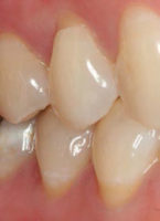 Setting the Record Straight About Toothpaste Abrasivity