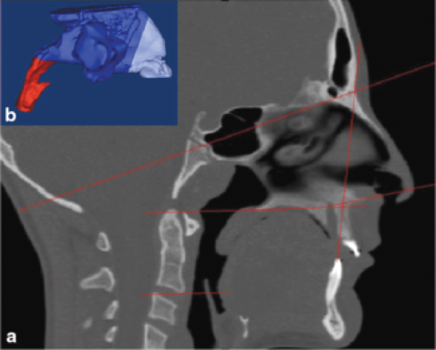 Airway Centered Dentistry: (The A, B, C’s of Treatment for Chronic Face ...