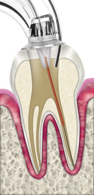 Kerr™ Endodontics Presents Endovac Pure™ - Oral Health Group