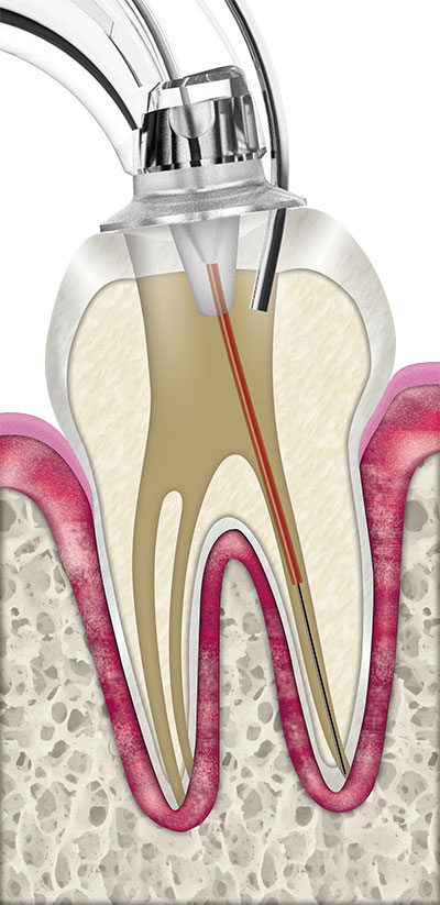 Kerr™ Endodontics Presents Endovac Pure™ - Oral Health Group