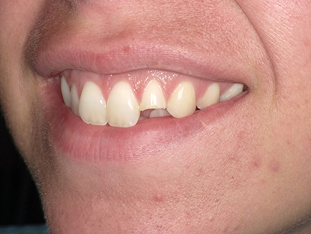 Restoring Damaged Tooth Structure with a Novel Resilient Bioactive ...