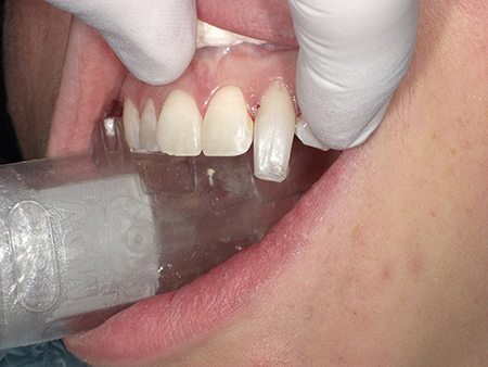 Restoring Damaged Tooth Structure with a Novel Resilient Bioactive ...