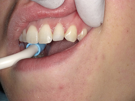 Restoring Damaged Tooth Structure with a Novel Resilient Bioactive ...