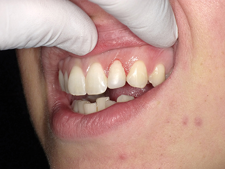 Restoring Damaged Tooth Structure with a Novel Resilient Bioactive ...