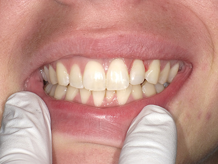 Restoring Damaged Tooth Structure with a Novel Resilient Bioactive ...