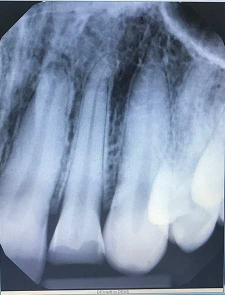 Restoring Damaged Tooth Structure with a Novel Resilient Bioactive ...