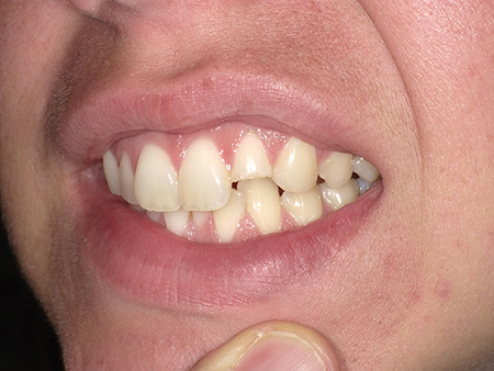 Restoring Damaged Tooth Structure with a Novel Resilient Bioactive ...