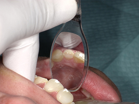Restoring Damaged Tooth Structure with a Novel Resilient Bioactive ...