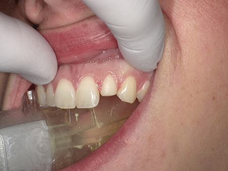 新型生物活性修复材料修复受损牙齿结构