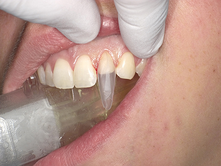 Restoring Damaged Tooth Structure with a Novel Resilient Bioactive ...