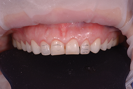 Porcelain Laminate Veneers: Full Digital Work Flow - Oral Health Group