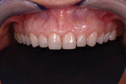 Porcelain Laminate Veneers: Full Digital Work Flow - Oral Health Group