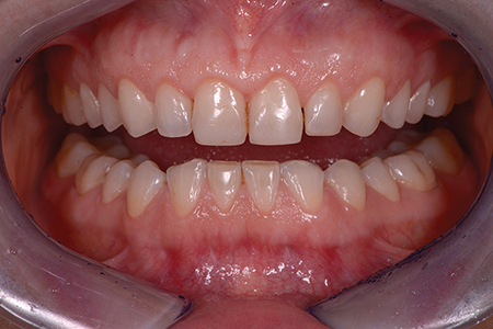 Porcelain Laminate Veneers: Full Digital Work Flow - Oral Health Group