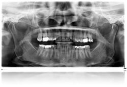 Laser-Assisted Aesthetic Osseous Crown Lengthening During the Crown ...