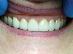 Laser-Assisted Aesthetic Osseous Crown Lengthening During the Crown ...